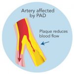 PADnet Arterial Testing | Pueblo Ankle and Foot Care, PLLC
